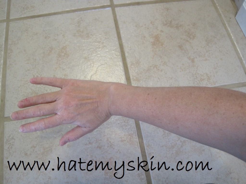 My hands, the journey of grossness. - I Hate My SkinI Hate My Skin